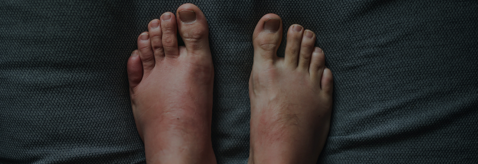 Angioedema: Causes, Symptoms, Types & Treatment - Allergyfree