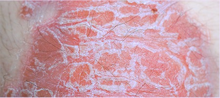 Psoriasis: Common Causes, Symptoms, Diagnosis, Treatment & Types