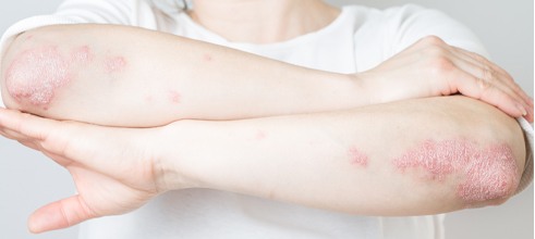 Skin Allergy: Types and Causes - Allergyfree