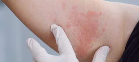 Urticaria (Hives) | Causes, Symptoms, Types & Treatment