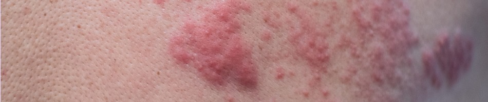 Urticaria (Hives) | Causes, Symptoms, Types & Treatment